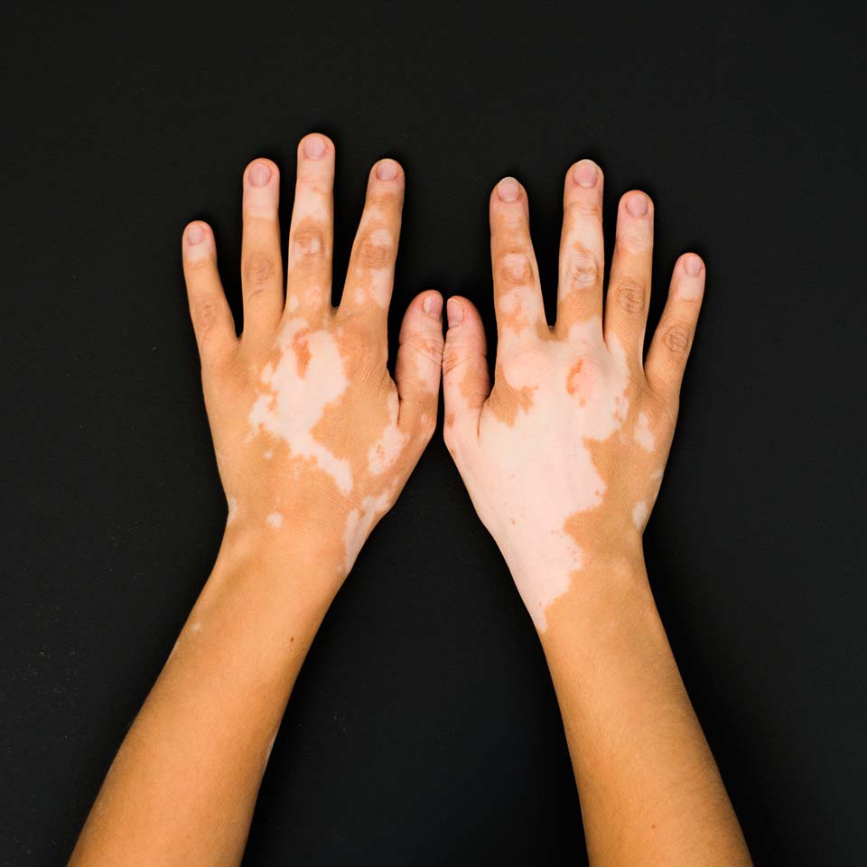 ¿El vitíligo es una enfermedad sin cura? - Salud y Cuidado